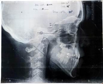 Prognatismo mandibular y micrognatismo maxilar: a propósito de un caso ...